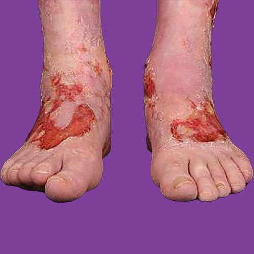 localized scleroderma types